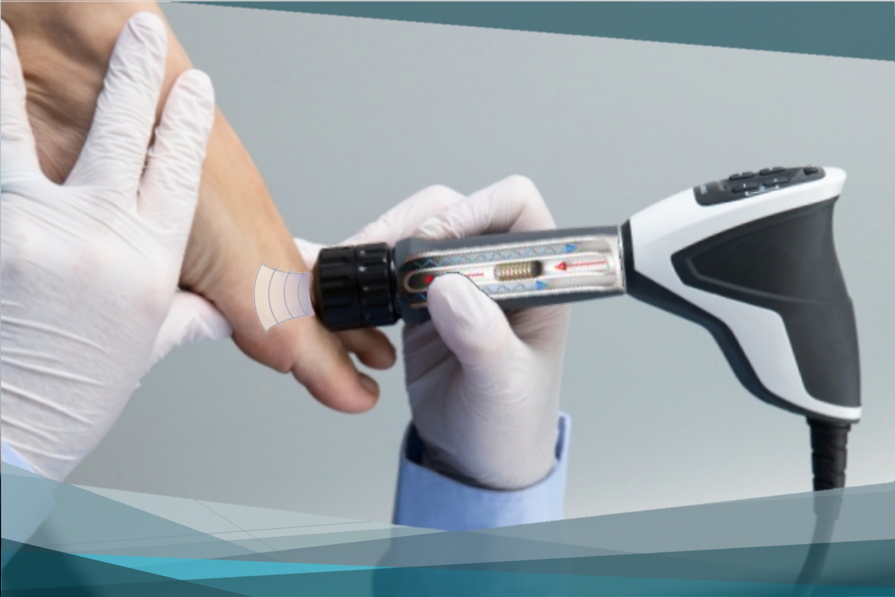 Shockwave Therapy; An Introduction - Quay Health