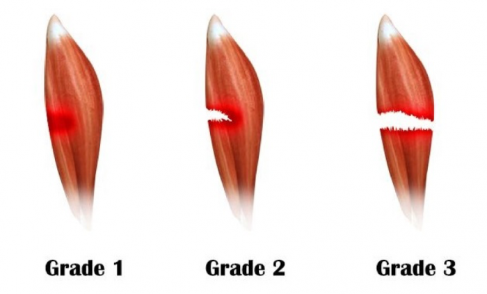 I’ve pulled a muscle…. What now? - Quay Health