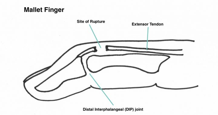 Mallet Finger - A common injury from playing ball sports - Quay Health