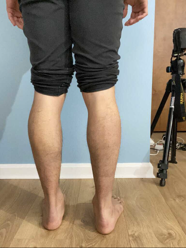 Tibialis Posterior Tendon Dysfunction – Quay Health