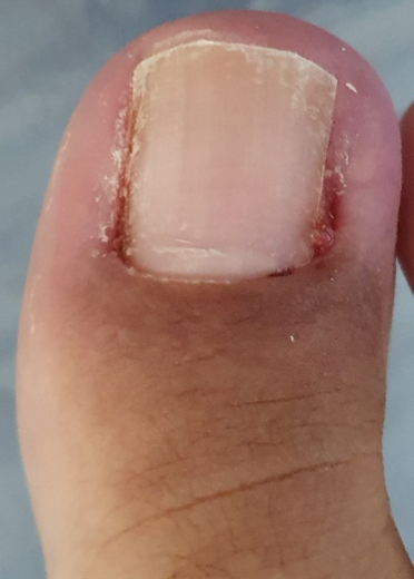 What is toenail surgery? - Quay Health